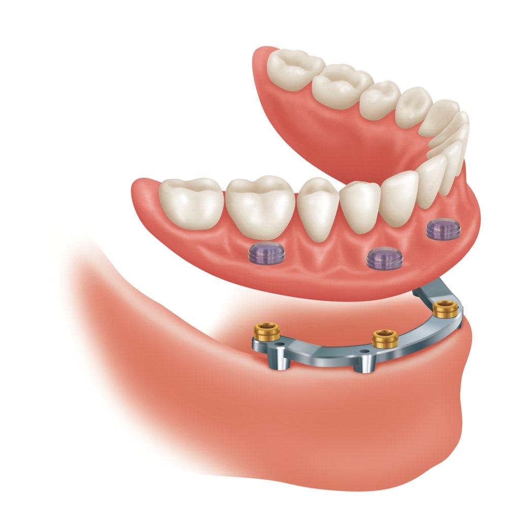 Implant-Supported Dentures | Osborne Family Dental